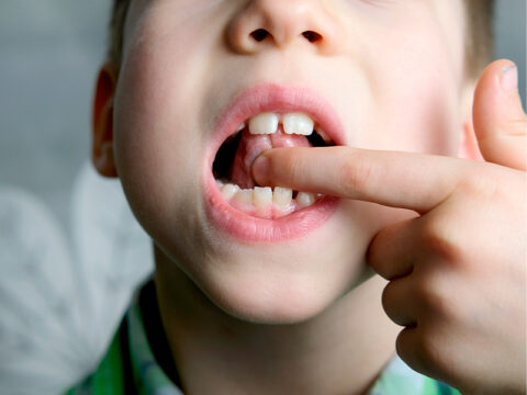 Tongue Tie Release What To Expect Before During And After The