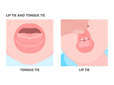 Understanding The Differences Between Tongue Tie And Lip Tie Tongue
